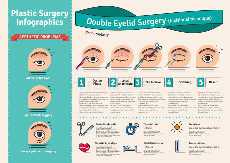 Vector Illustrated Set with Double Eyelid Surgery Stock Illustration ...