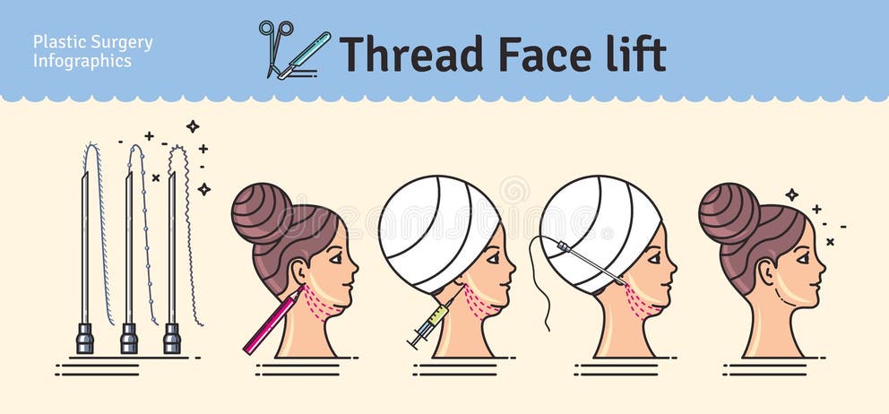 Vector Illustrated Set with Face Lifting Surgery by Threads Stock ...