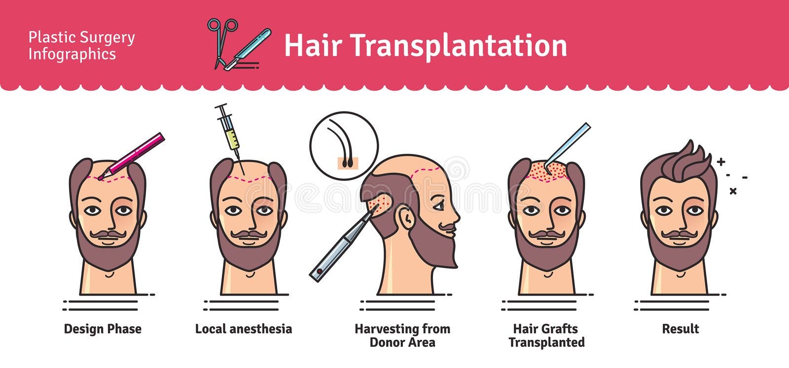Alopecia Stages Set Hair Loss Balding Process Stock Vector