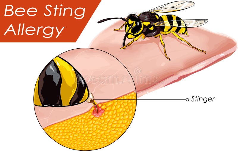 Vector Illustration of a Bee Sting Allergy Stock Vector - Illustration ...