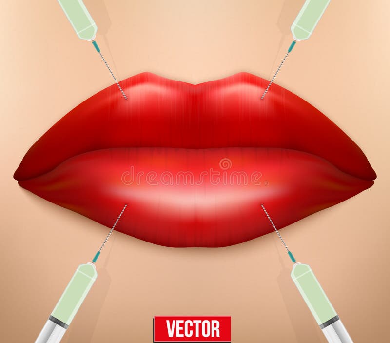 Vector Illustration of a Botox Injection. Stock Vector - Illustration ...