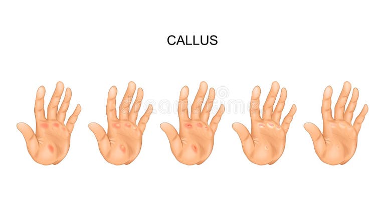 Calluses on hands stock vector. Illustration of anatomy - 147844383