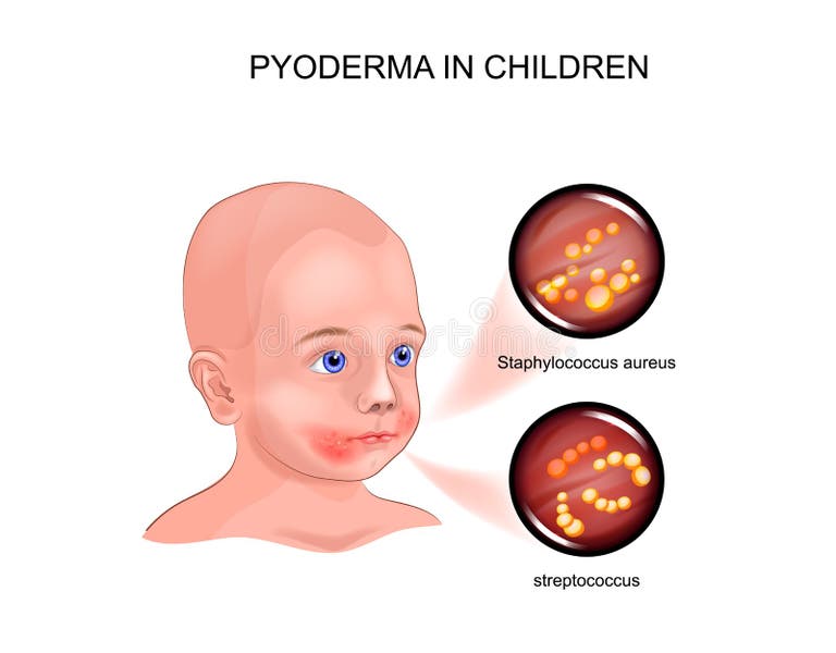 Pyoderma in child stock vector. Illustration of hive - 128872114