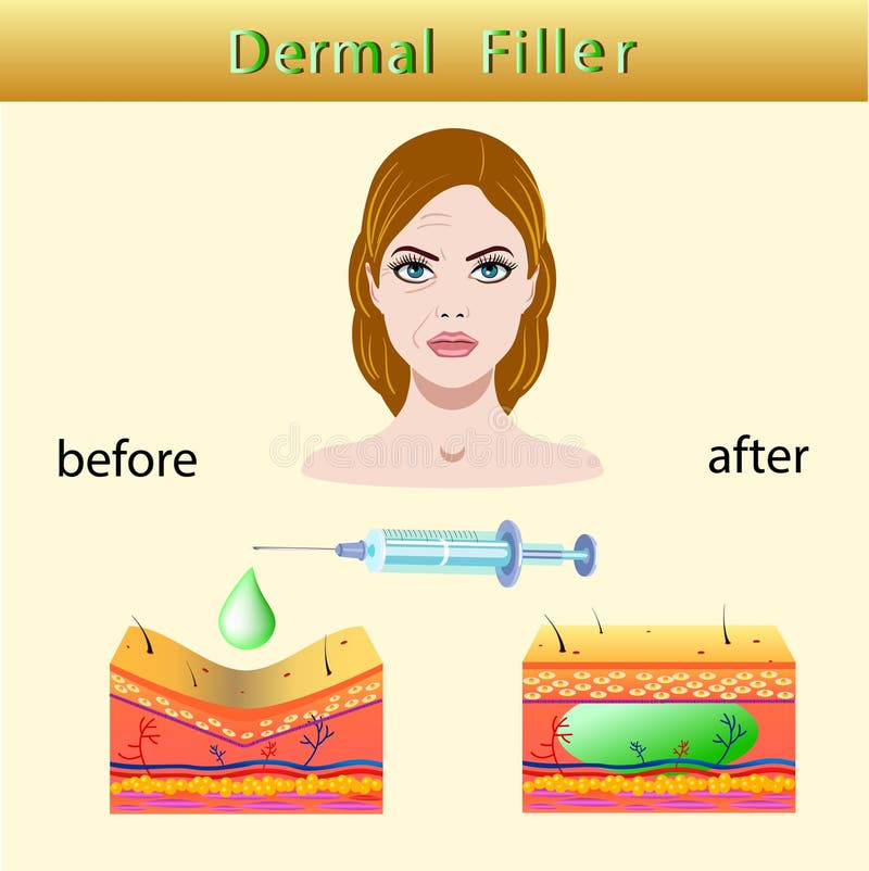 Vector Illustration with Cosmetic Filler or Dermal Fillers on Light ...