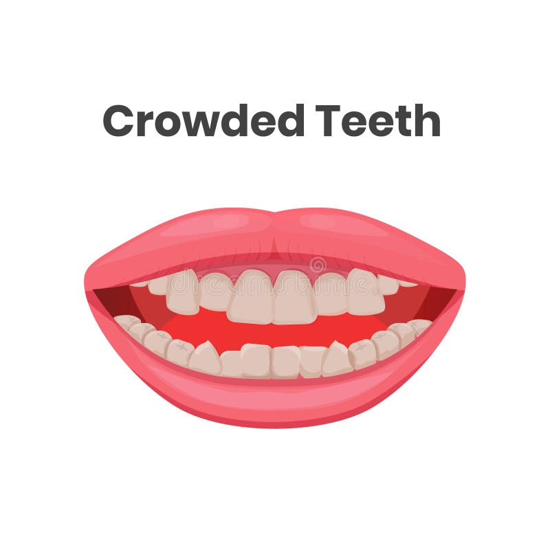 Vector Illustration of the Crowded, Yellow Teeth Stock Vector ...
