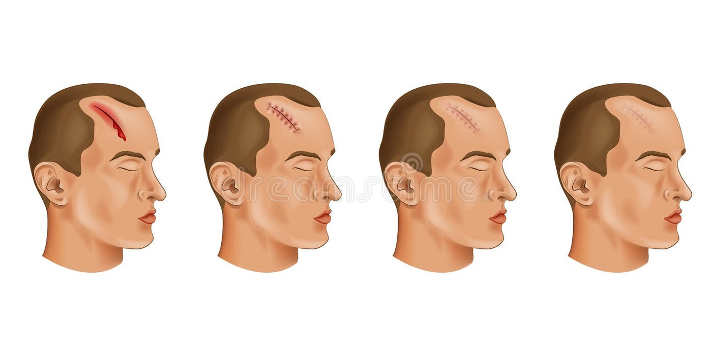 Head Incision Stock Illustrations – 66 Head Incision Stock ...
