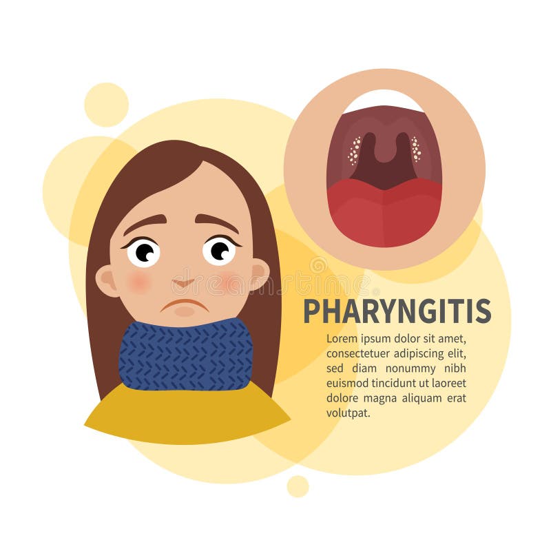 Pharyngitis infographics stock vector. Illustration of angina - 123215758
