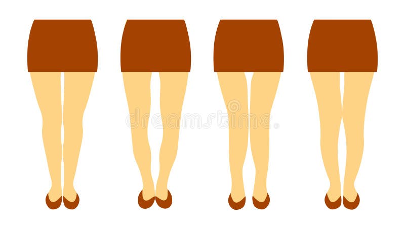 Shapes Of The Legs.Normal And Curved Legs.Knock Knees.Bowed Leg Stock ...