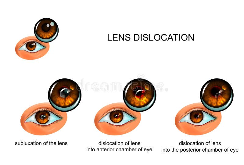 Dislocation of the Lens of the Eye Stock Vector - Illustration of iris, barley: 116661209