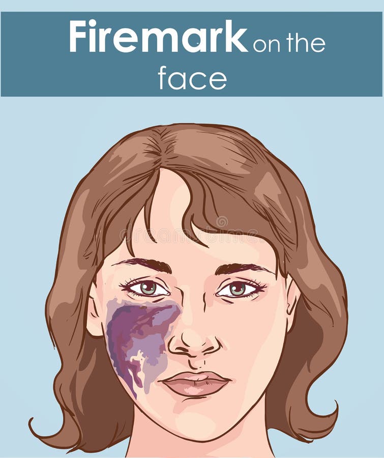 Vector Illustration of a Firemark on the Face. Stock Vector ...
