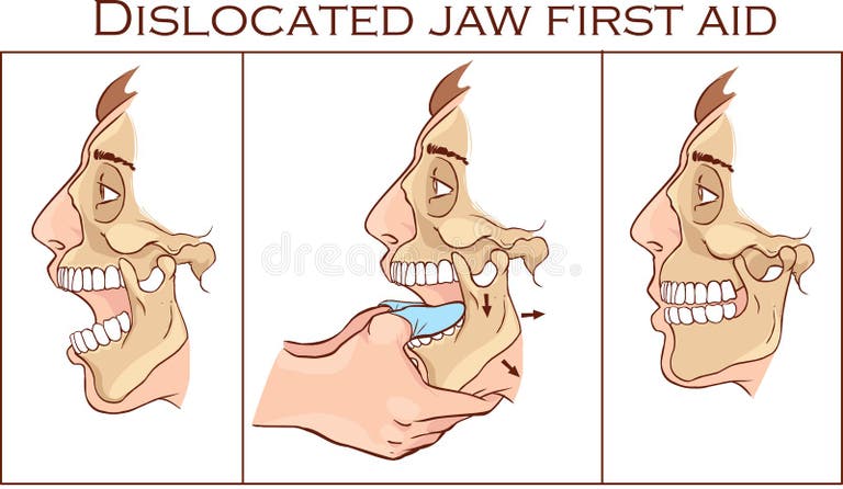 Vector Illustration of a First Aid Dislocated Jaw Stock Vector ...