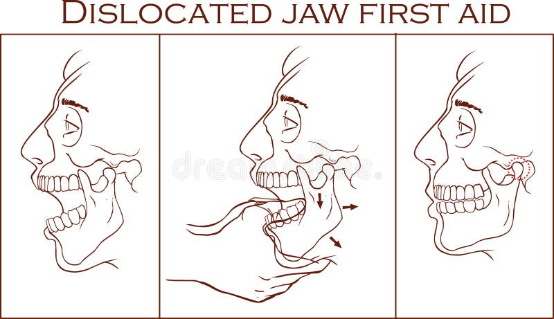 Vector Illustration of a First Aid Dislocated Jaw Stock Vector ...