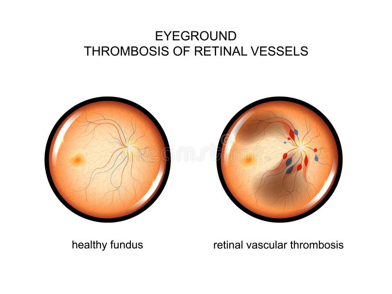 Fundus. Retinal Vascular Thrombosis Stock Vector - Illustration of ...