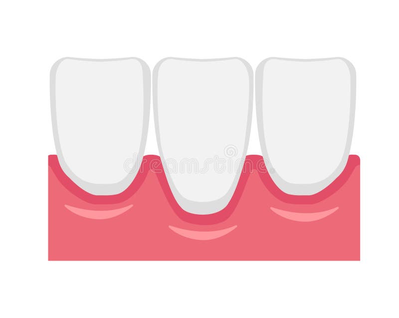 Vector Illustration of Gingival Recession Stock Vector - Illustration ...