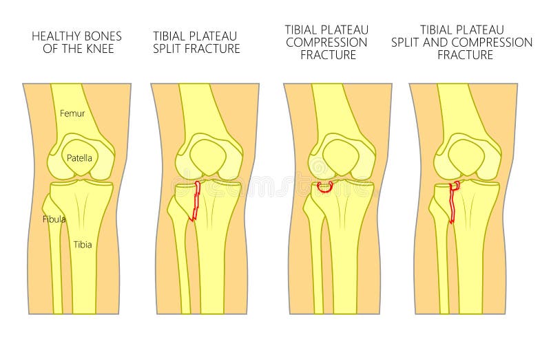 Transverse Bone Fracture. Infographics. Vector Illustration on a Lined ...