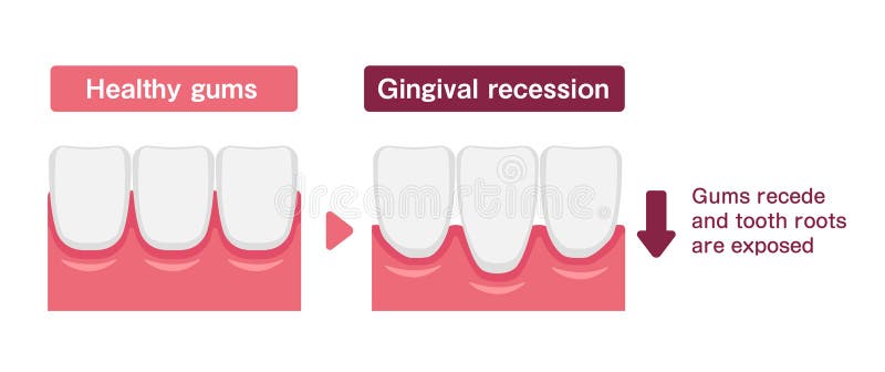 Vector Illustration of Healthy Gums and Gingival Recession Stock Vector ...