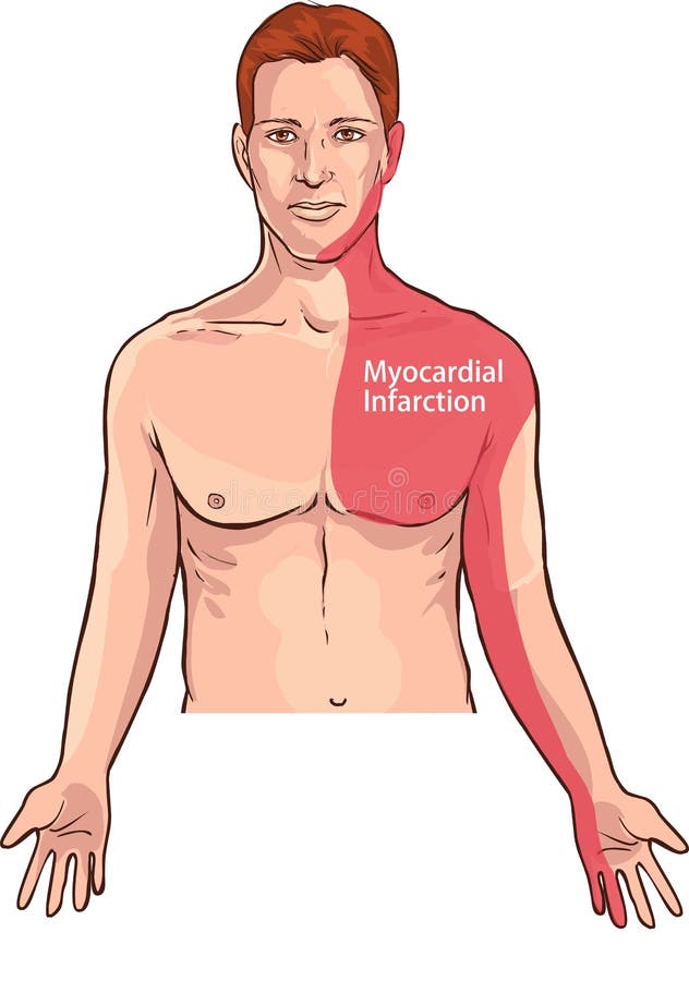 Vector Illustration of a Heart Attack Pain Location Myocardial ...