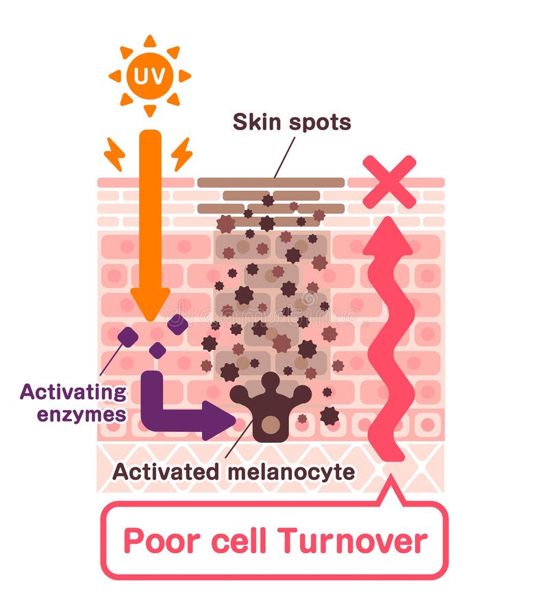 Illustration of How Skin Spots (hyperpigmentation) are Created Stock ...