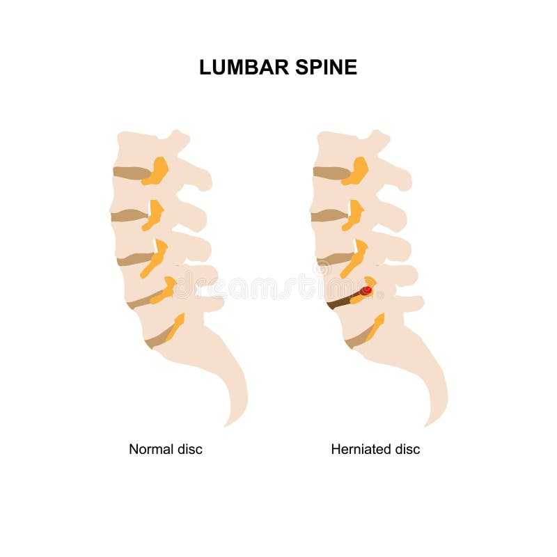 Vector Illustration of Human Lumbar Spine on White Background Stock ...