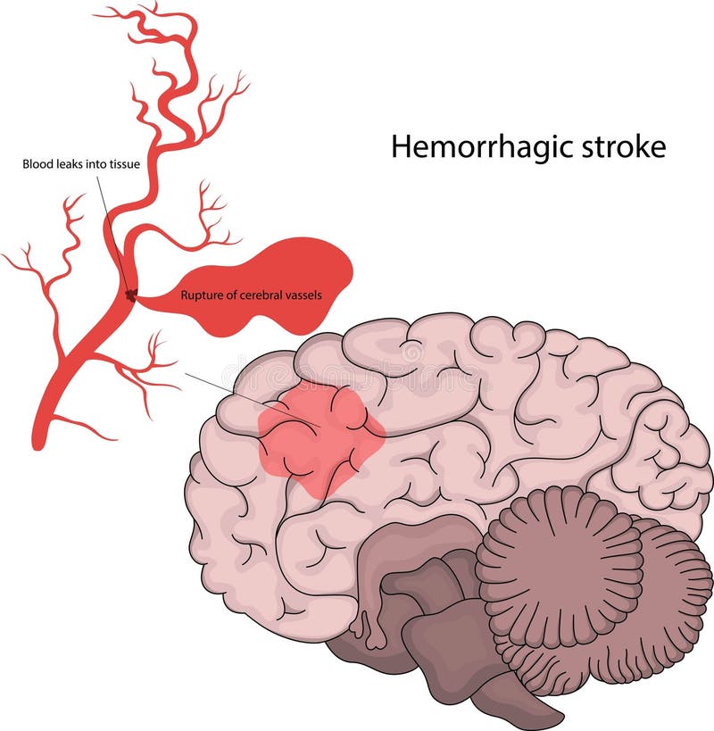 Vector Illustration of Hemorrhagic Stroke. Stock Vector - Illustration ...