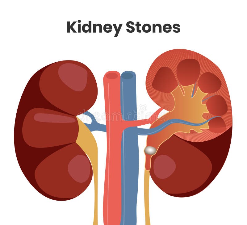 Vector Illustration of the Kidney Stones. Obstruction of the Urether ...