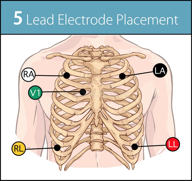5 Lead Ecg Placement