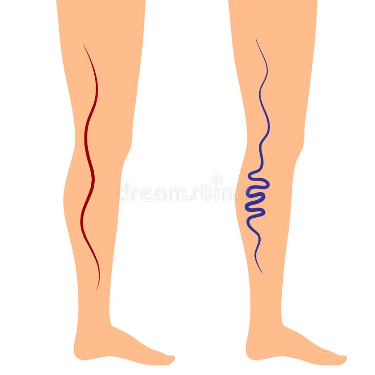 Leg Veins Stock Illustrations 998 Leg Veins Stock Illustrations Vectors And Clipart Dreamstime