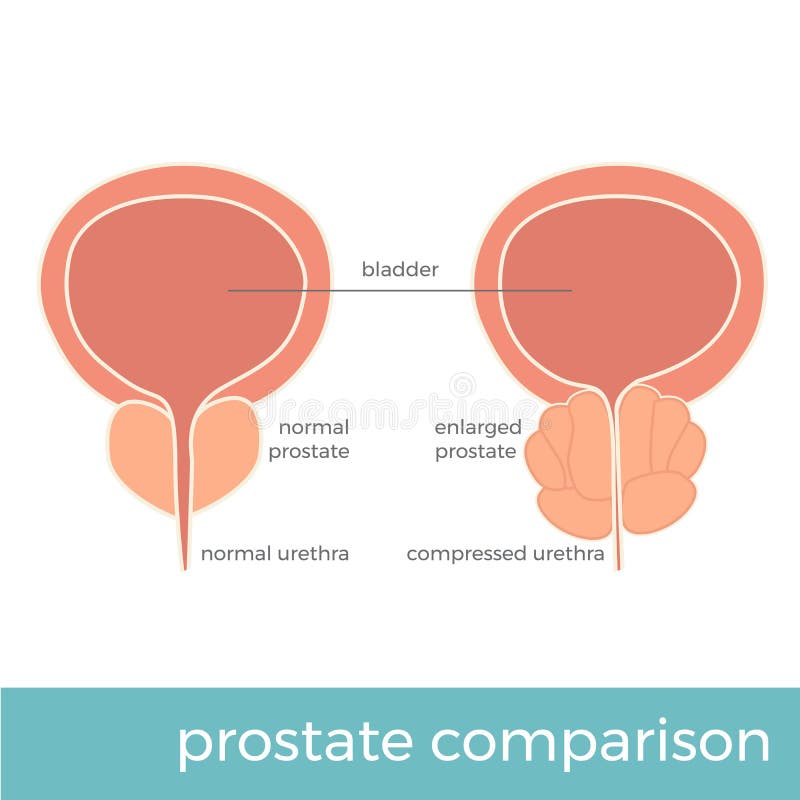 Vector Illustration of Normal and Enlarged Prostate Stock Vector ...