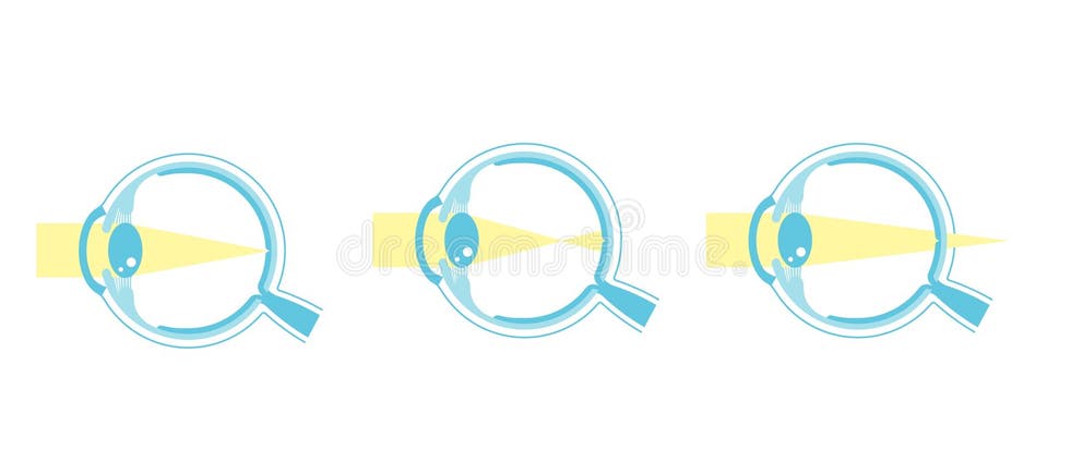 Vector Illustration of Normal Vision and Myopia and Hyperopia Stock ...