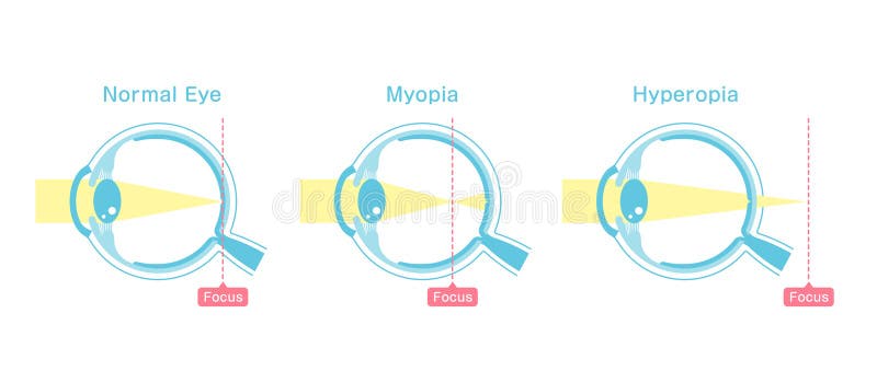 Myopia, Hyperopia and Astigmatism. Common Vision Disorders and Its ...
