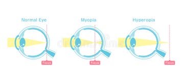 Vector Illustration of Normal Vision and Myopia and Hyperopia Stock ...