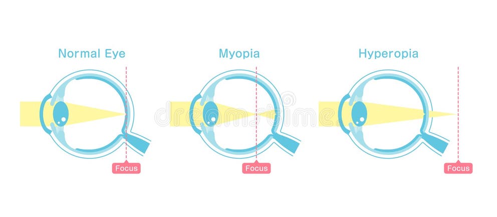 Vector Illustration of Normal Vision and Myopia and Hyperopia Stock ...