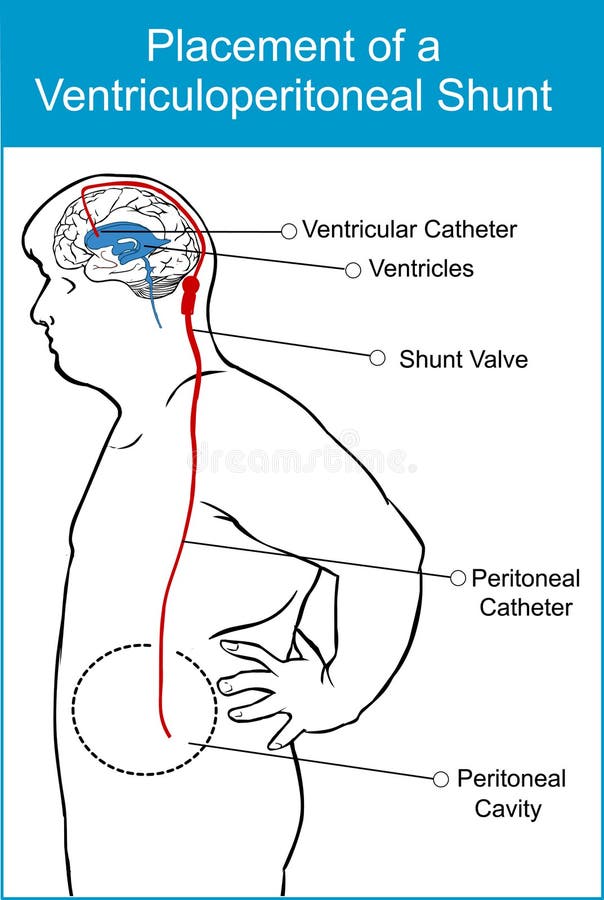 Placement of a Ventriculoperitoneal Shunt Stock Vector - Illustration ...