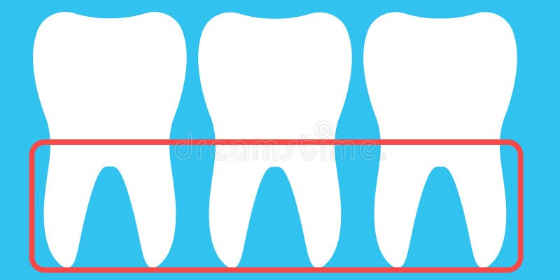 Vector Illustration of a Row of Teeth in the Gingiva Stock Vector ...
