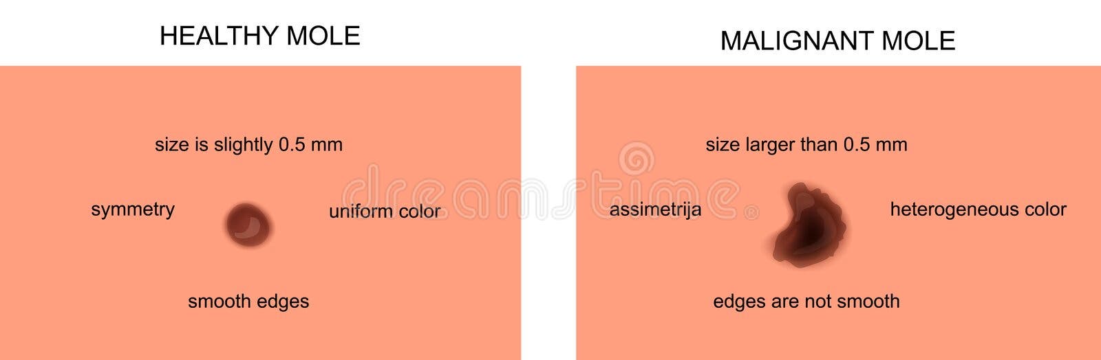 Signs of Malignant Melanoma and Mole. Skin Cancer Stock Illustration ...