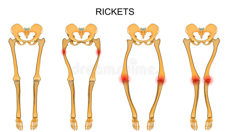 The Skeleton of the Lower Limbs in Rickets Stock Vector - Illustration ...
