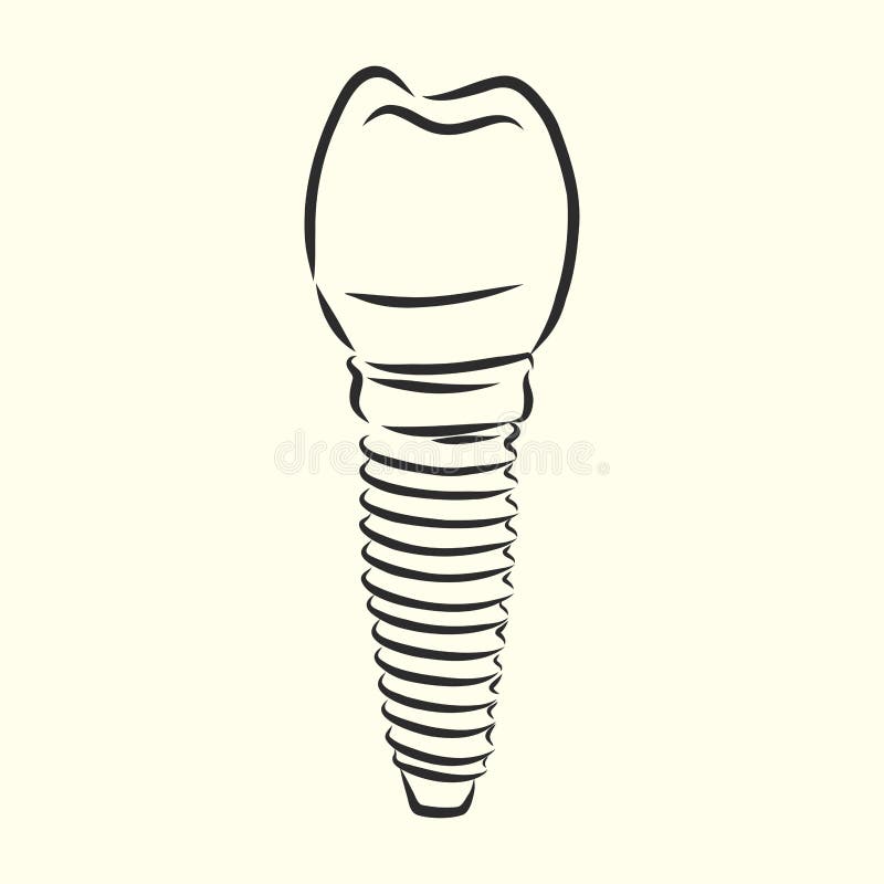 Vector Illustration. Sketches, Dental Implants. Dental Implant, Vector ...