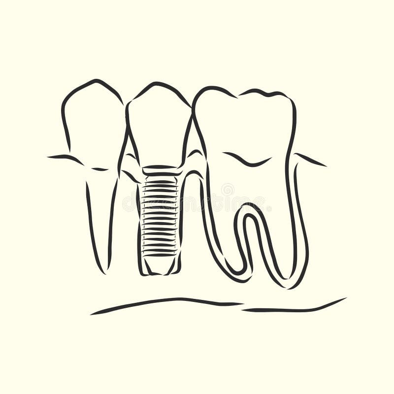 Vector Illustration. Sketches, Dental Implants. Dental Implant, Vector ...