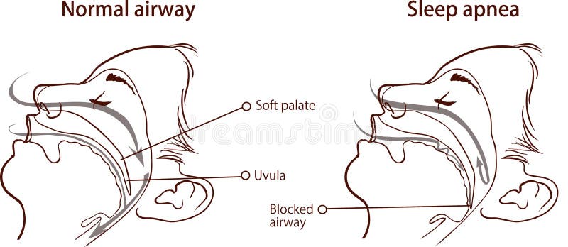 VECTOR ILLUSTRATION OF A SLEEP APNEA SYNDROME Stock Vector ...