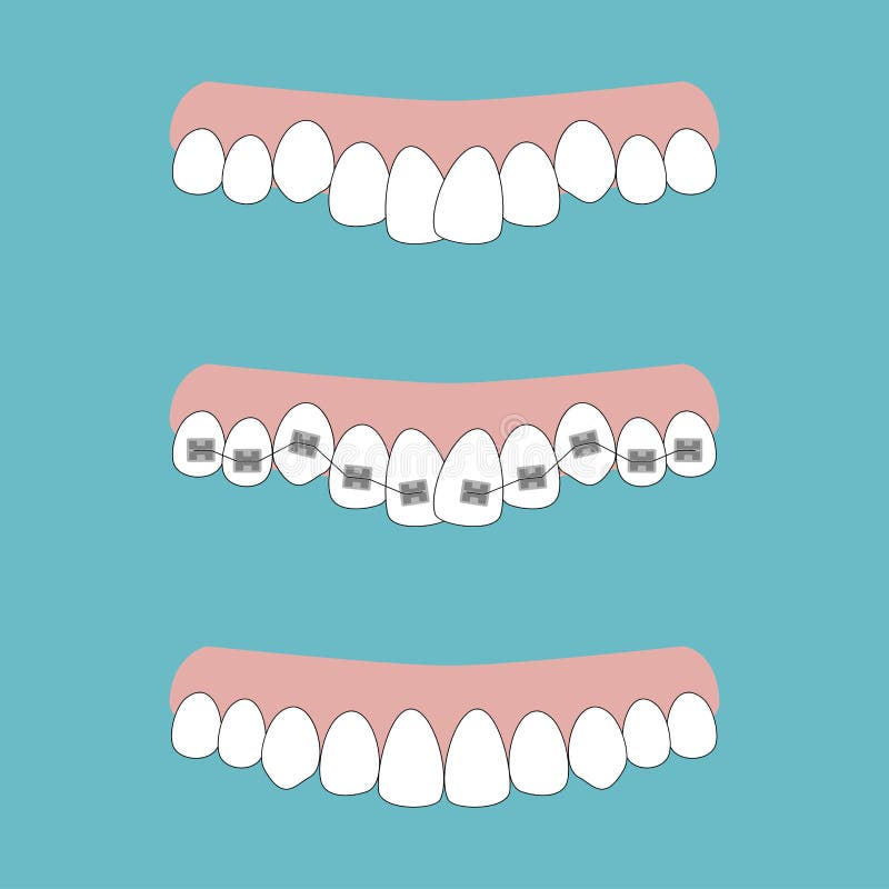 Vector Illustration of the Stages of Orthodontic Treatment Braces on ...