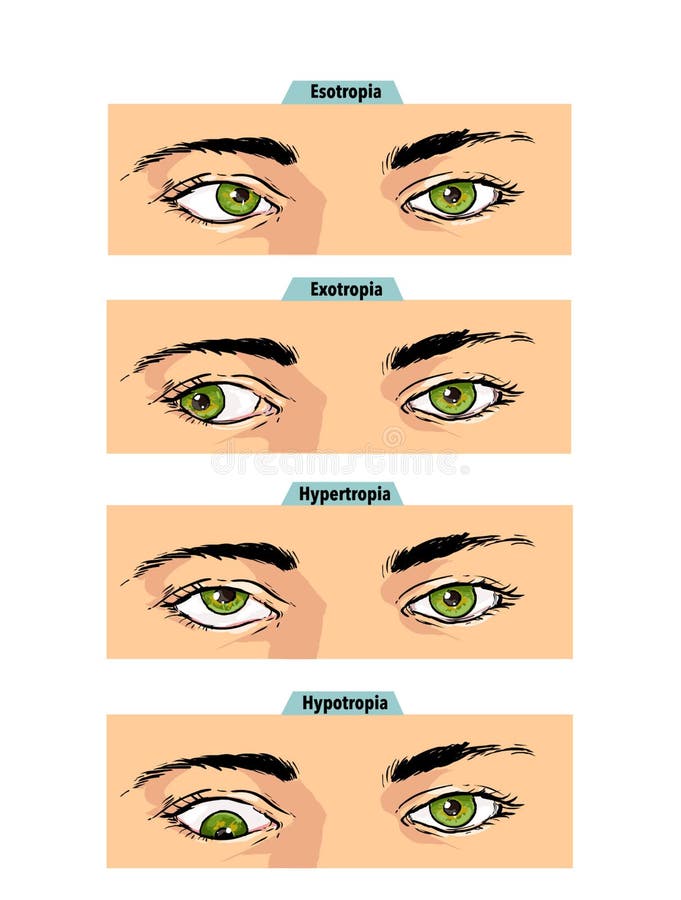 Vector Illustration of a Strabismus or Crossed Eyes Stock Vector ...