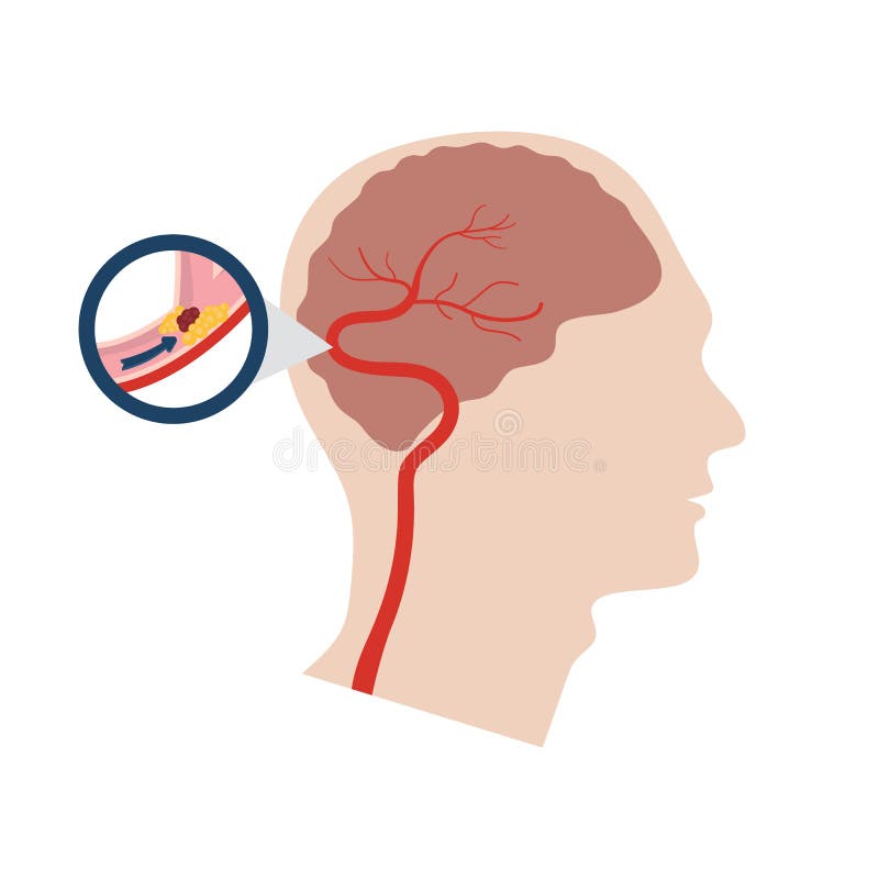 Vector Illustration of a Stroke Stock Vector - Illustration of ...