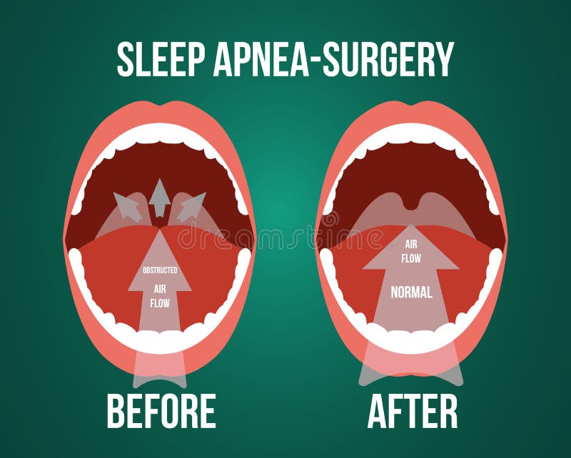 Vector Illustration of Surgery for Obstructive Sleep Apnea. Stock ...