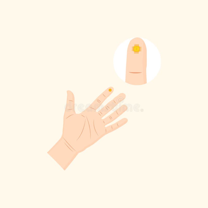 A Microchip Implanted Under the Skin in a Human Hand. Vector ...