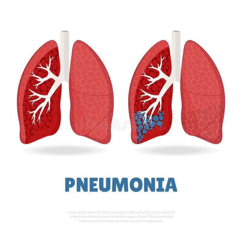 Pneumonia Stock Illustrations – 108,982 Pneumonia Stock Illustrations ...