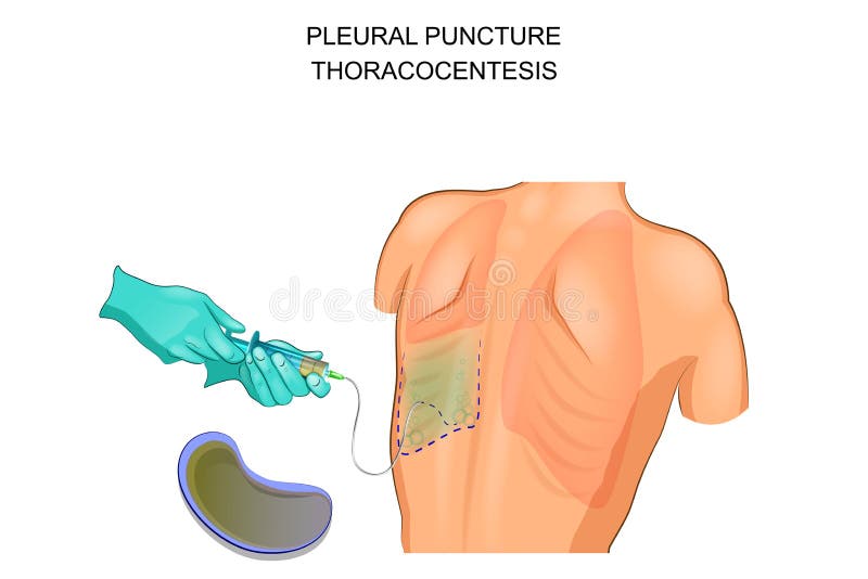 Thoracocentesis, Pleural Puncture Stock Vector - Illustration of ...