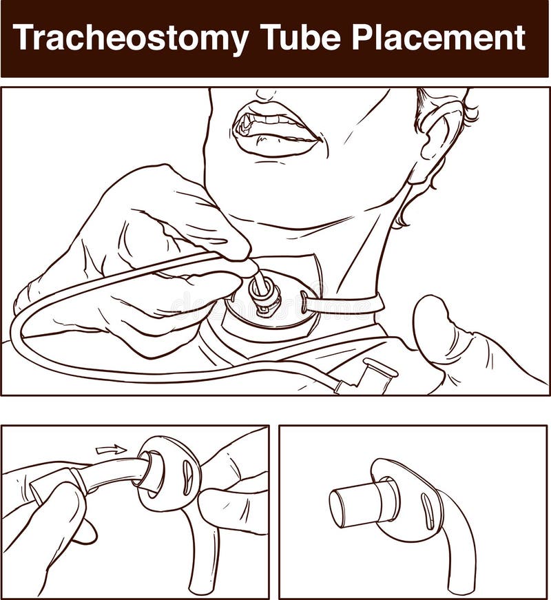 Tracheostomy Stock Illustrations – 70 Tracheostomy Stock Illustrations ...