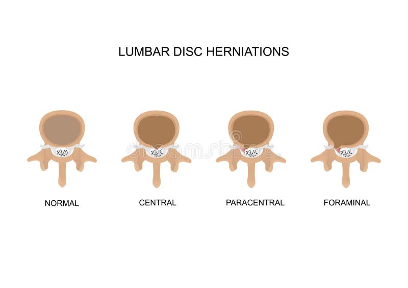 Type of Lumbar Disc Herniations Stock Vector - Illustration of cross ...