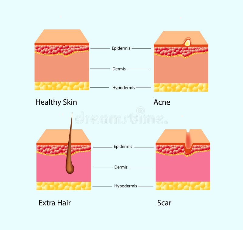 Dermis Problems Stock Illustrations – 125 Dermis Problems Stock ...