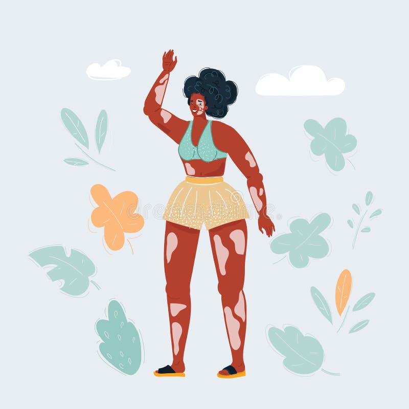 Vitiligo Stock Illustrations 464 Vitiligo Stock Illustrations